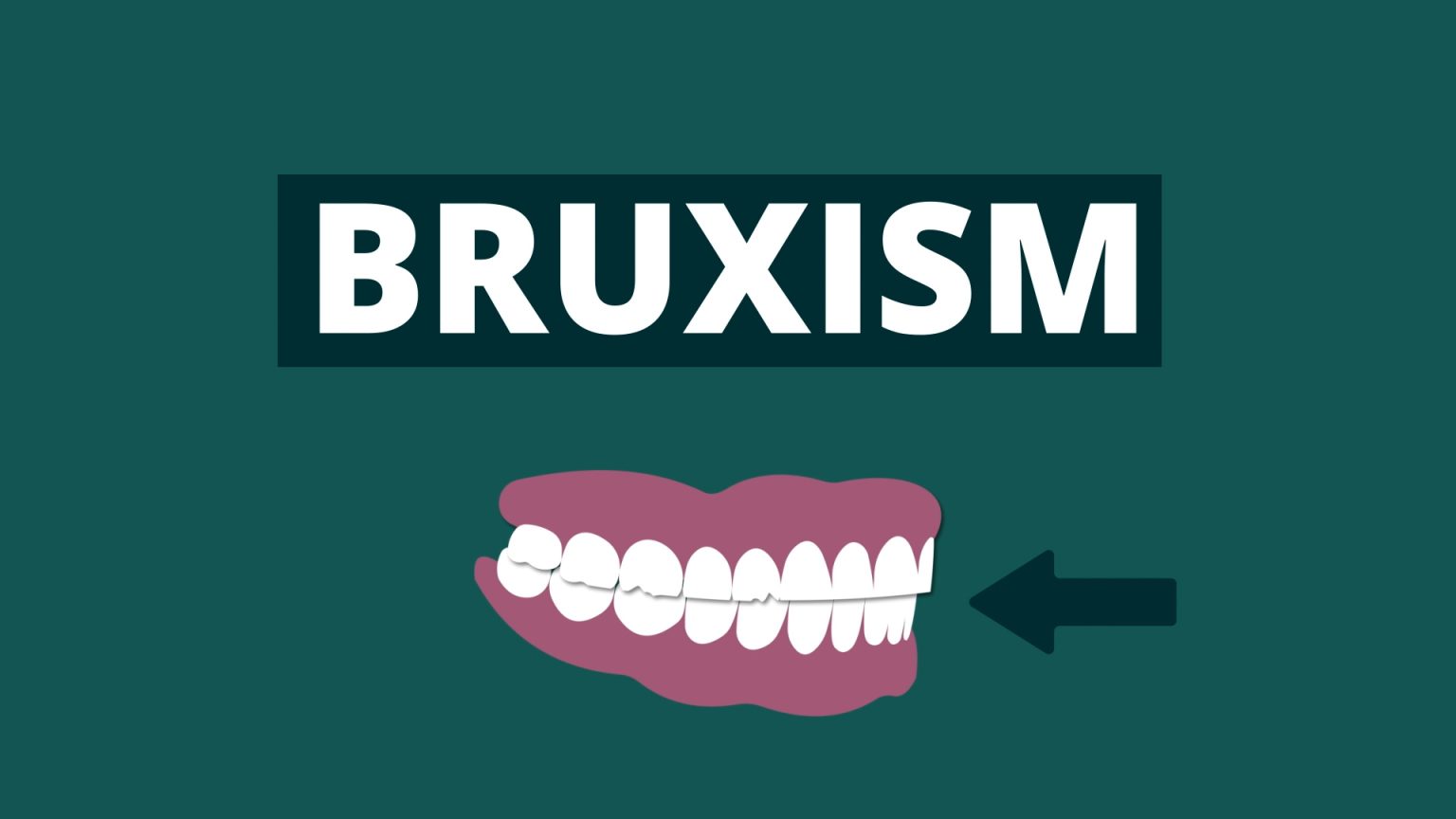 How A Custom Mouthguard Can Keep Your Smile Protected - White Rock ...